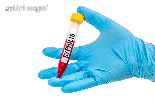 Test-tube with blood sample for SYPHILIS 이미지 (592407340) - 게티이미지뱅크