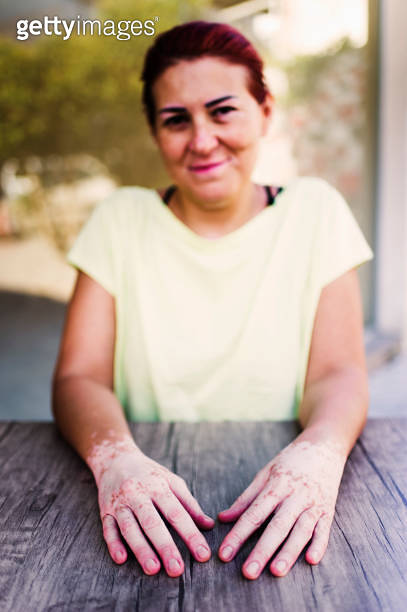 Leukoderma (Vitiligo), localized loss of pigmentation. 이미지 (613549524 ...