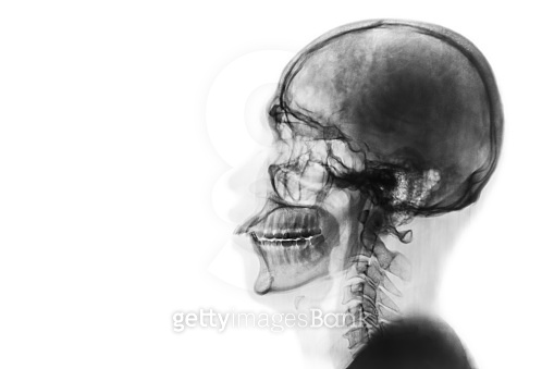 X-ray normal skull and cervical spine . Lateral view . Invert color ...