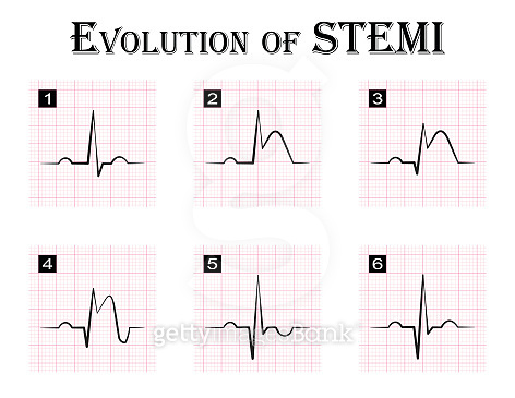 ECG of evolution ( step by step ) of STEMI ( ST elevation myocardial ...