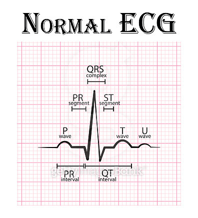 Normal ECG ( Electrocardiogram ) ( P wave , PR segment , PR interval ...