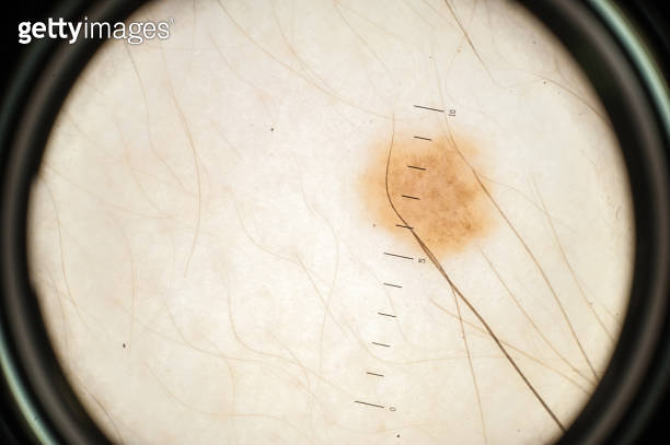 Magnification of Skin Mole through Dermatoscope 이미지 (693844070) - 게티이미지뱅크