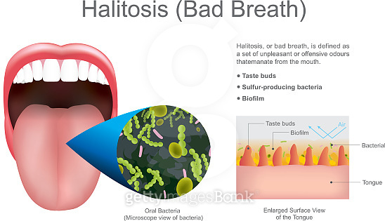 Halitosis (bad breath). Education info graphic. Vector design. 이미지 ...