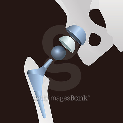 structure of the artificial hip joint, vector illustration 이미지 ...