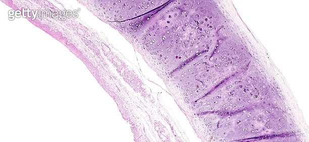 Histology of human tissue, show squamous metaplasia of bronchial mucosa ...