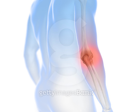 3D Render of Osteoarthritis - rheumatoid arthritis in the human elbow ...