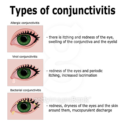 Types of conjunctivitis (697180698) 일러스트, 무료 일러스트 - 게티이미지뱅크