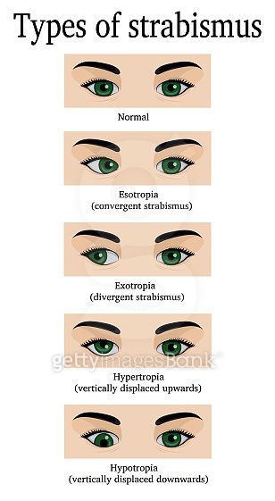 Types of strabismus (697279134) - 게티이미지뱅크