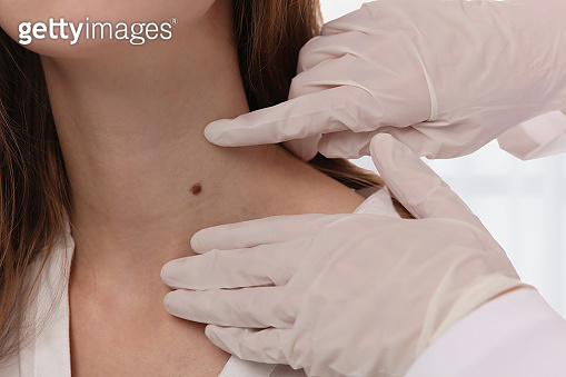 Doctor dermatologist examines birthmark of patient close up. Checking ...