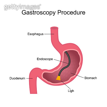 Gastroscopy Procedure Diagram (864998700) 일러스트, 무료 일러스트 - 게티이미지뱅크