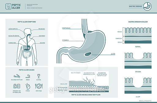 Peptic ulcer and helicobacter pylori infographic 이미지 (693740826) - 게티이미지뱅크