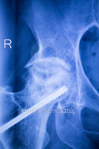 Hip joint replacement xray showing ball and socket joint's titanium ...