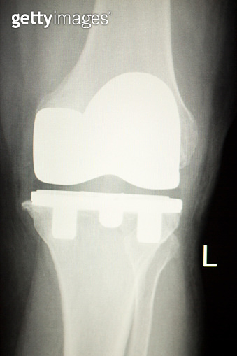 Knee joint replacement orthopedic titanium metal Traaumatology ball and ...