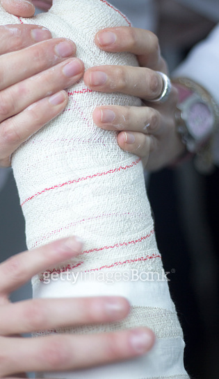 Doctor applying a plaster cast and bandages to patient forearm and ...