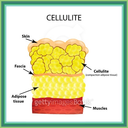 Cellulite. The anatomical structure of the adipose tissue. Infographics ...