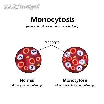 Monocytes above the normal range in the blood. Monocytosis. Vector ...