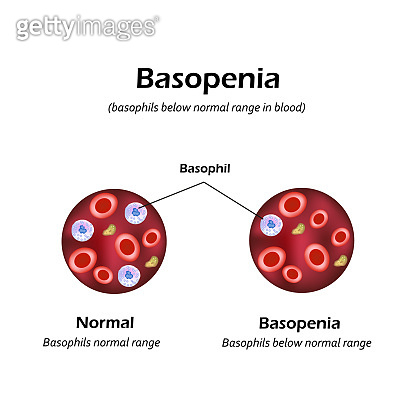 Basophils below the normal range in the blood. Basopenia. Infographics ...