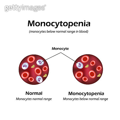Monocytes below the normal range in the blood. Monocytopenia. Vector ...
