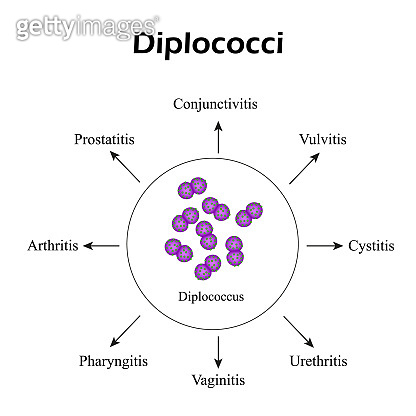 Diplococci. The disease is caused diplococci. Infographics. Vector ...