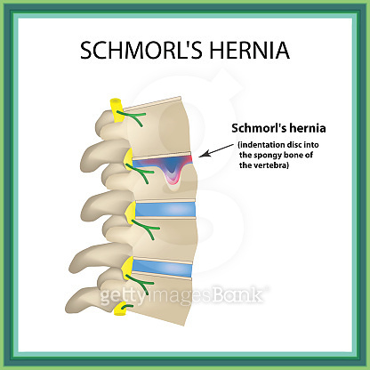 Hernia Schmorl. Intervertebral disc. Side view. Spine. Infographics ...