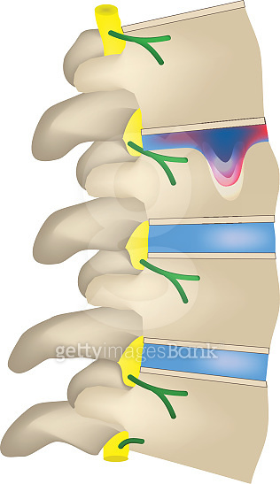 Hernia Schmorl. Intervertebral disc. Side view. Spine. Infographics ...