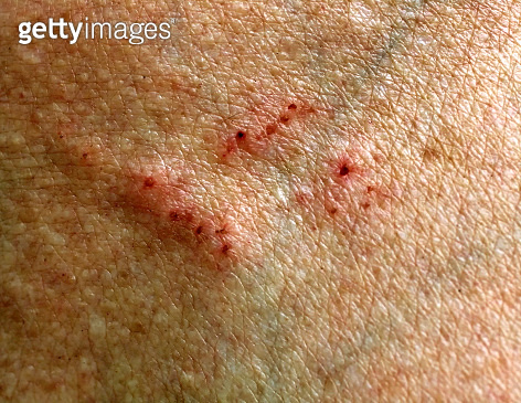 Cuts and scratches on the skin. Wounds and abrasions (845341366) - 게티이미지뱅크