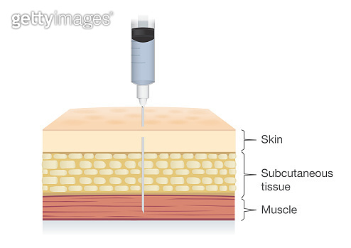 Injection needle insert medications into the muscle layer of skin ...