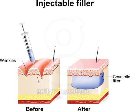injectable cosmetic filler. How it works (645164838) - 게티이미지뱅크