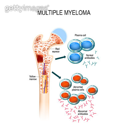Multiple myeloma is a cancer of the bone marrow. 이미지 (881911948) - 게티이미지뱅크