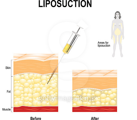 Human Skin layer before and after Liposuction 이미지 (645164856) - 게티이미지뱅크
