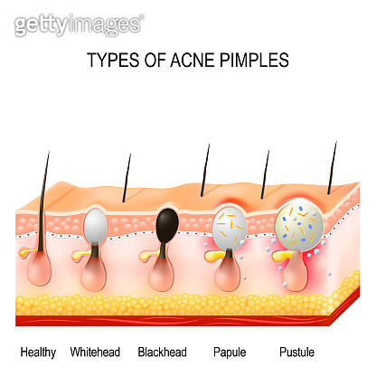 Types of acne pimples 이미지 (860995716) - 게티이미지뱅크