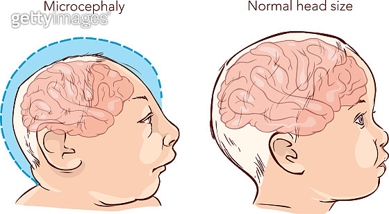 Illustration of a newborn baby with Microcephaly disease caused by Zika ...