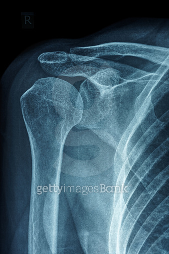 X-ray film of primary frozen shoulder or adhesive capsulitis of Asian ...
