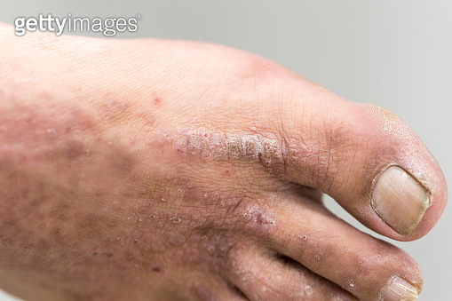 Atopic dermatitis (AD), also known as atopic eczema, is a type of ...