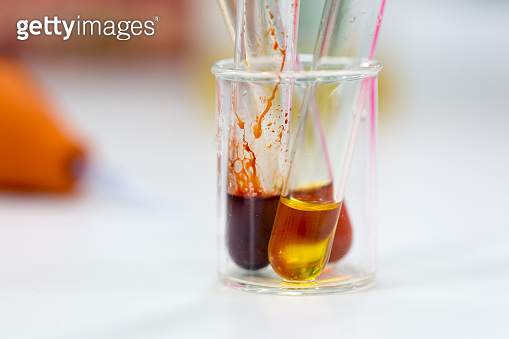 Experiment chemical of urine with Benedict s solution in the laboratory ...