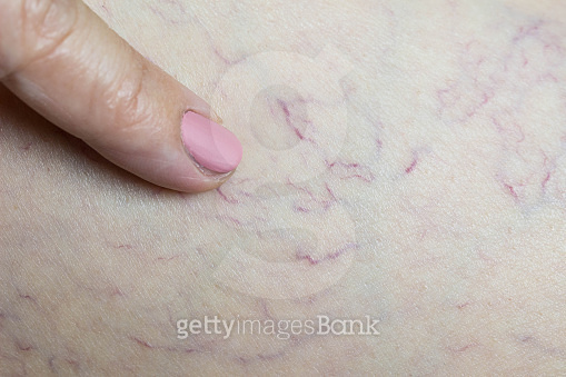 Varicose veins under woman skin 이미지 (807364618) - 게티이미지뱅크