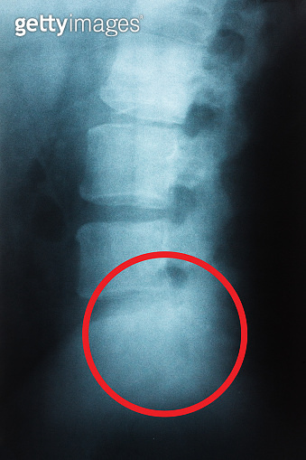 Film x-ray lumbar spine , L-S spine AP,Lateral view Grade ...