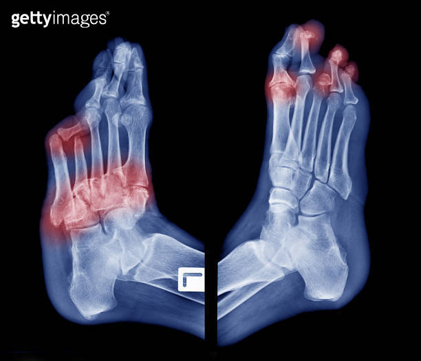 X-ray image of diabetic feet, oblique view show amputation toes and ...