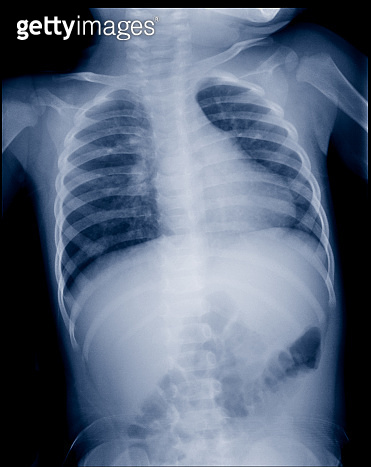 X-ray image of chest and body in child (945203788) - 게티이미지뱅크