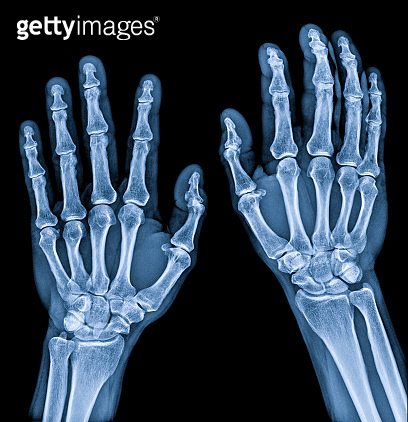 Normal male Hand x-ray both side process in blue tone (945206766) - 게티이미지뱅크