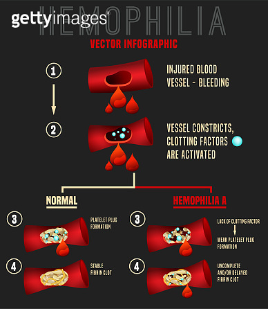 Hemophilia Infographics Image 이미지 (1081652628) - 게티이미지뱅크