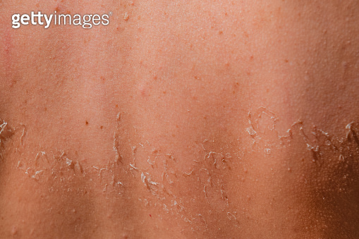 Sunburn on the skin of the back. Exfoliation, skin peels off. Dangerous ...