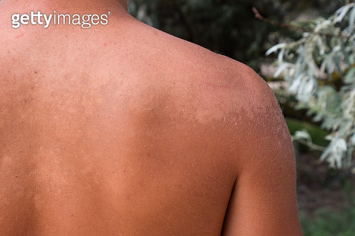 Sunburn on the skin of the back. Exfoliation, skin peels off. Dangerous ...