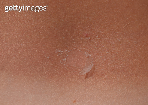 Sunburn on the skin of the back. Exfoliation, skin peels off. Dangerous ...