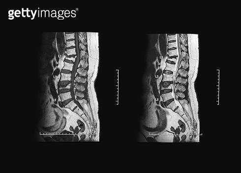 MRI scan of lumbosacral (LS) spine, without (left) and with contrast ...