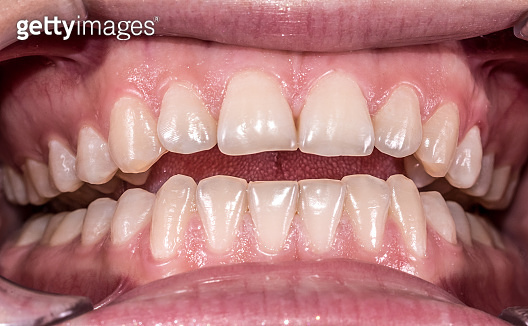 Healthy human teeth with normal occlusion from frontal view 이미지 ...