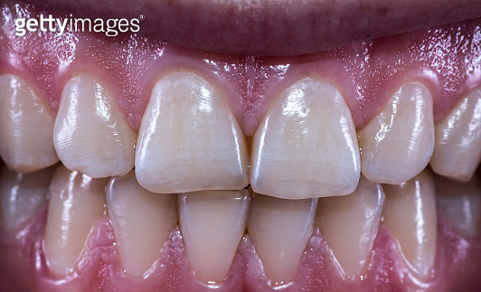 Healthy human teeth with normal occlusion from frontal view . 이미지 ...
