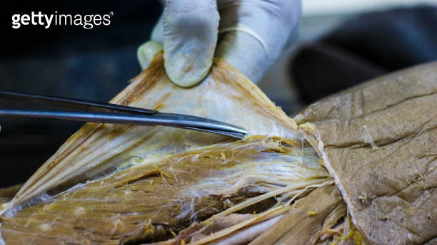 Anatomy dissection of a cadaver showing adductor canal using scalpel ...