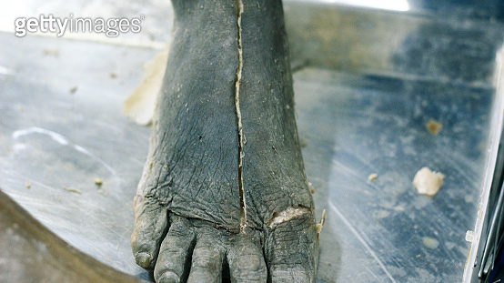 Anatomy dissection of a cadaver showing dorsum of foot using scalpel ...