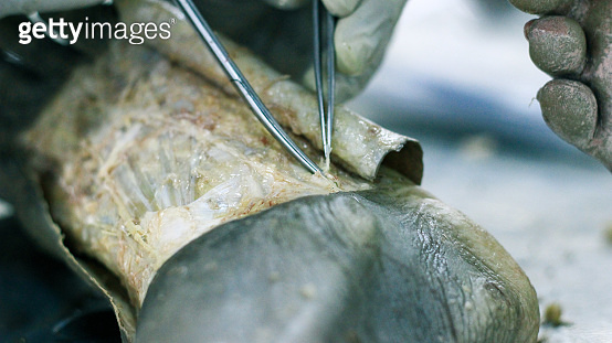 Anatomy dissection of a cadaver showing dorsum of foot using scalpel ...